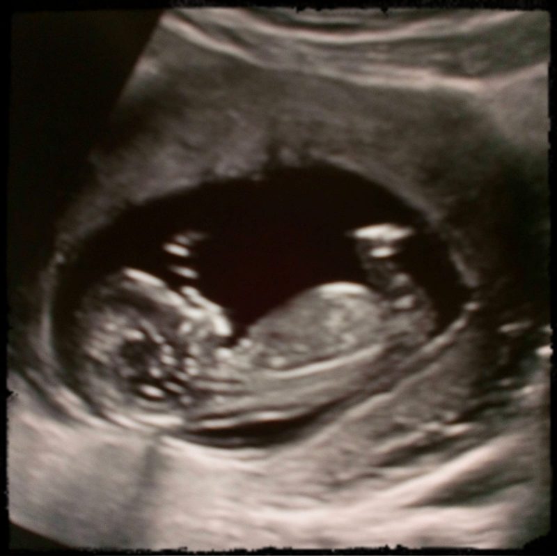 Ecografía de las 12 semanas y test prenatal no invasivo – La aventura ...